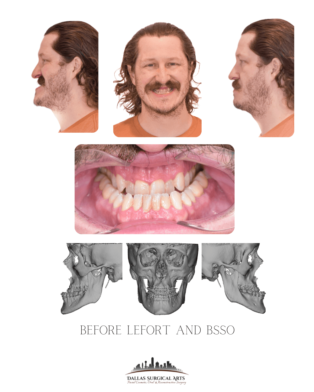 Jaw Repositioning (Orthognathic Surgery) | Dallas Surgical Arts